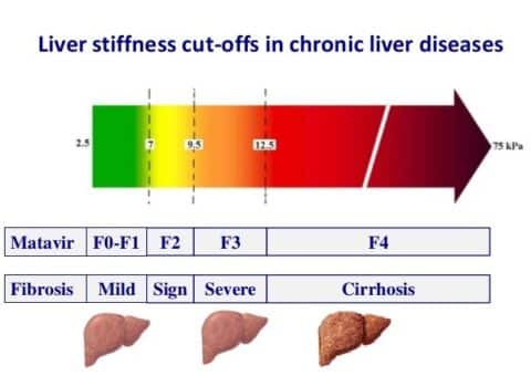 The Path to Liver Health & Understanding Liver Stiffness